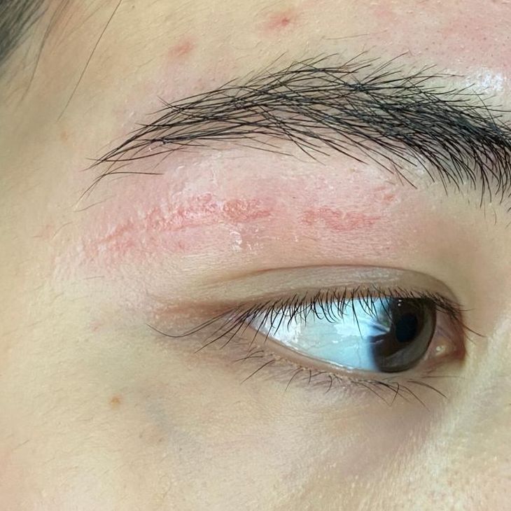 Is It Ok To Wax Eyebrows After Skin Peeled Hester Leted2000